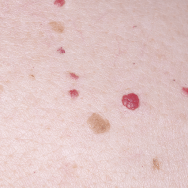 Effective Cherry Angioma Removal | Treatment at Eden Medical