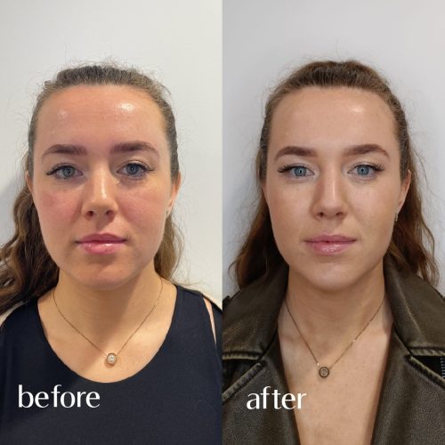 Masseter Botox Treatment - Jaw Pain Relief & Face Slimming
